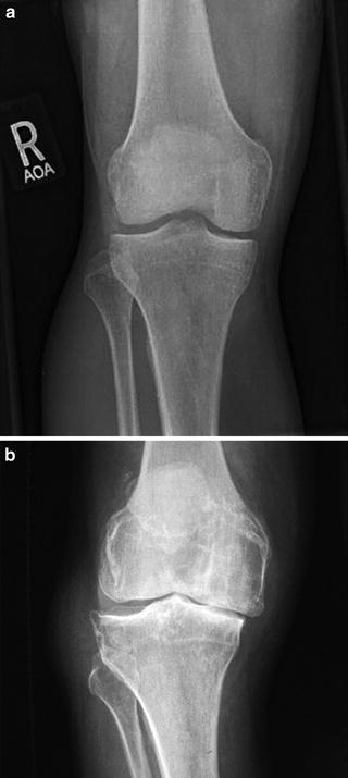 Immediate Swelling After Trauma to the Knee | Basicmedical Key