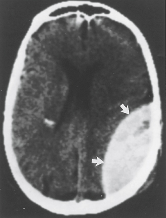 Head Trauma | Basicmedical Key
