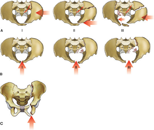 The Principles of Orthopedic Surgery for Trauma | Basicmedical Key