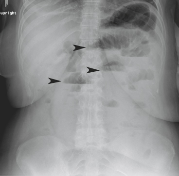Ileus and Bowel Obstruction | Basicmedical Key