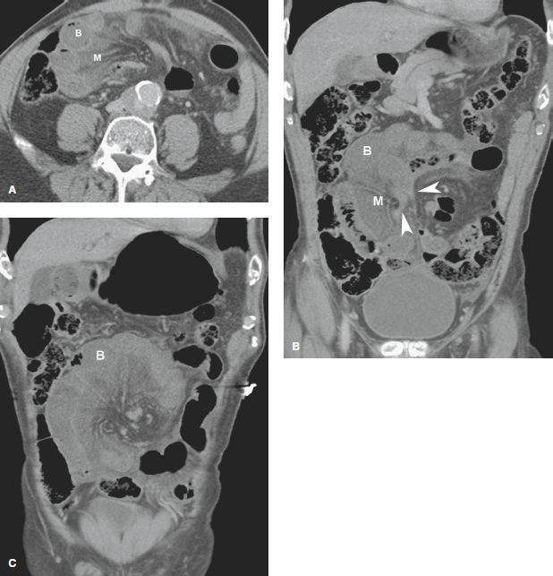 Ileus and Bowel Obstruction | Basicmedical Key