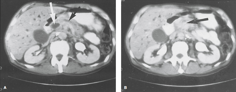 Neoplasms of Exocrine Pancreas | Basicmedical Key