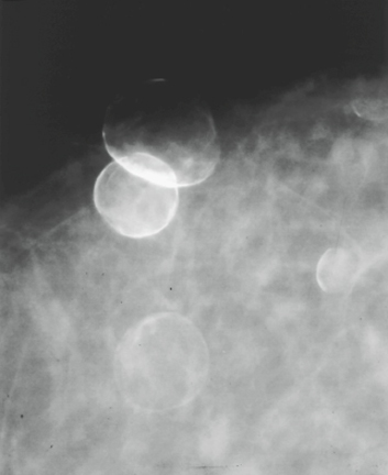 Breast Disease | Basicmedical Key