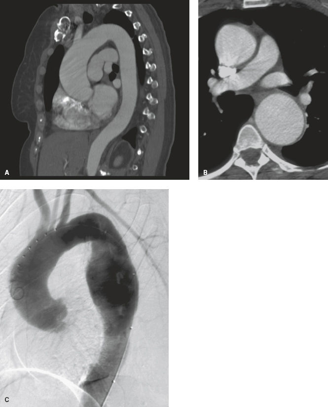 Thoracic Aortic Aneurysms and Aortic Dissection | Basicmedical Key