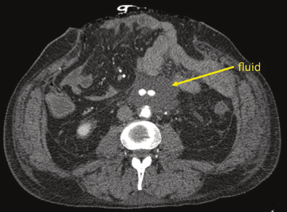 Vascular Infection | Basicmedical Key