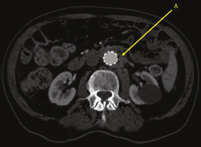 Vascular Infection | Basicmedical Key