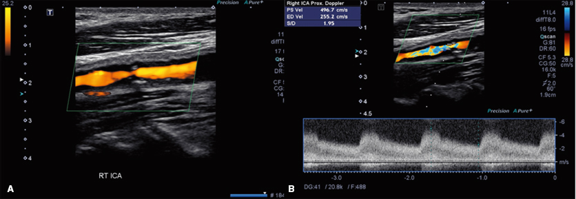 Cerebrovascular Disease | Basicmedical Key