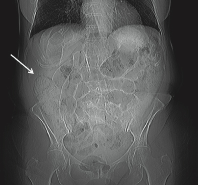 Renal and Splanchnic Vascular Disease | Basicmedical Key