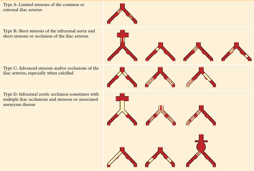 Aortoiliac Disease | Basicmedical Key