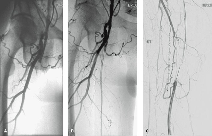 Peripheral Arterial Disease | Basicmedical Key