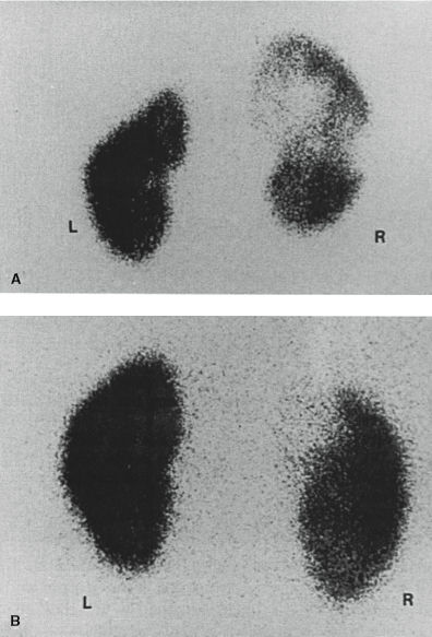 Pediatric Genitourinary System | Basicmedical Key