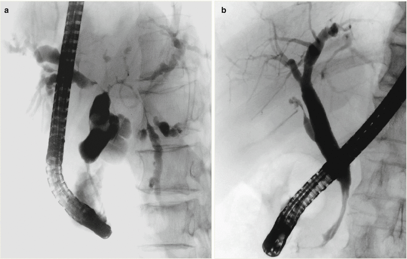 Igg4 Related Sclerosing Cholangitis Basicmedical Key