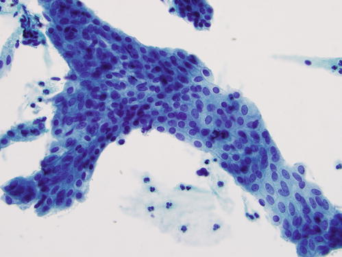 Non-Neoplastic Findings | Basicmedical Key