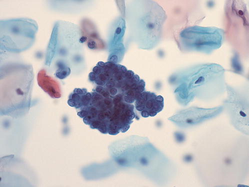 Non-Neoplastic Findings | Basicmedical Key