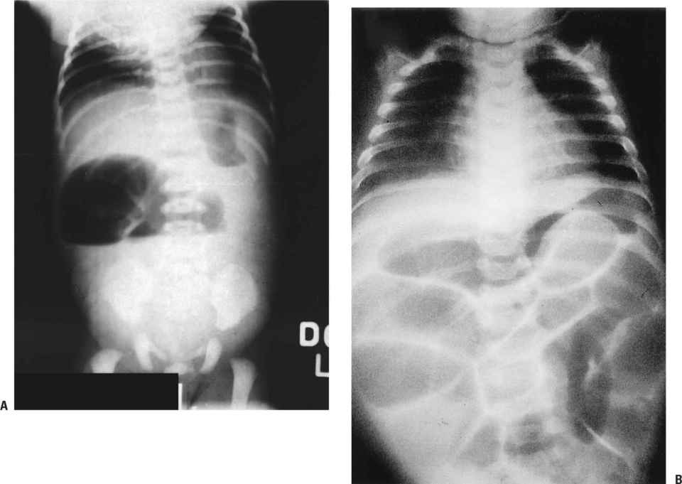 Pediatric Surgery: Surgical Diseases Of Children | Basicmedical Key