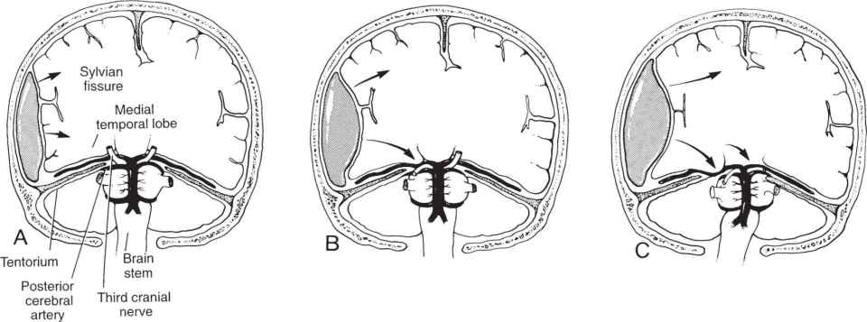 Neurosurgery: Diseases Of The Nervous System | Basicmedical Key
