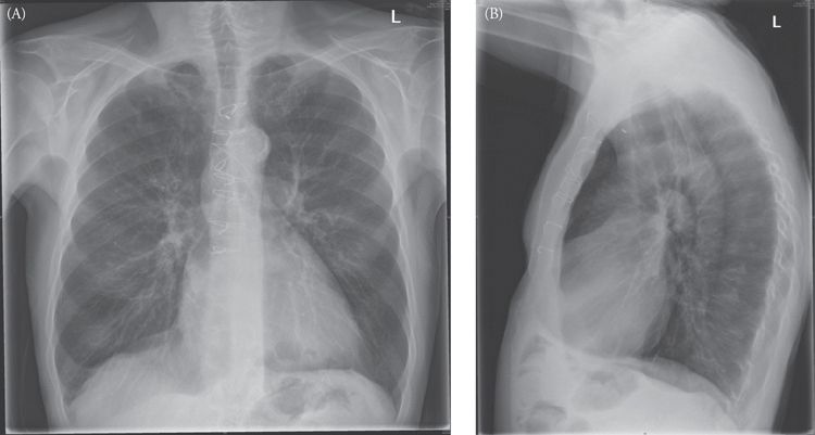 Chronic Obstructive Pulmonary Disease | Basicmedical Key