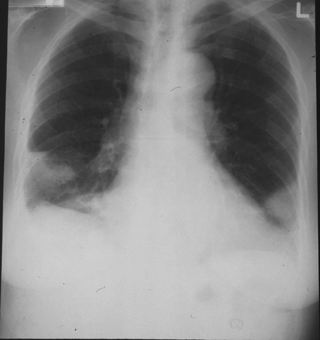 Chest X-Ray Refresher | Basicmedical Key