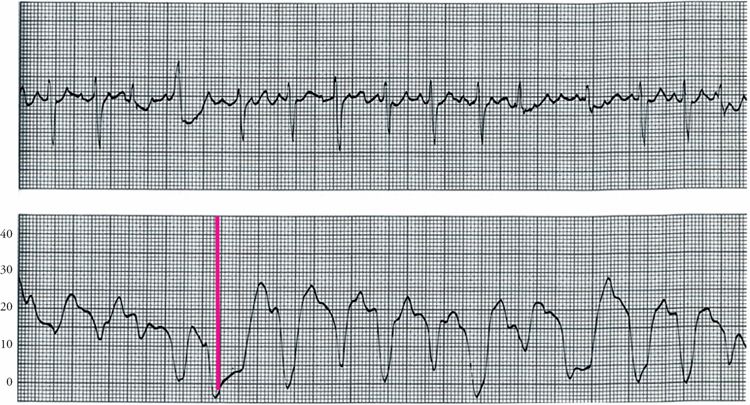 Hemodynamic Monitoring in the ICU | Basicmedical Key