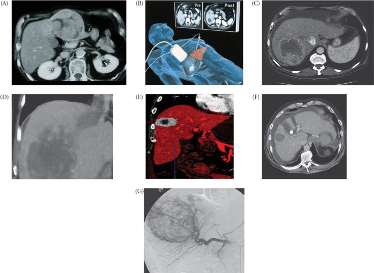Liver Disease | Basicmedical Key