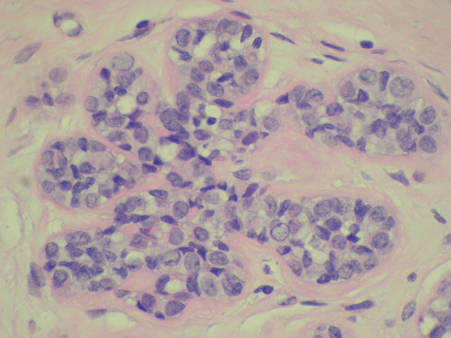 Lobular Lesions (Lobular Neoplasia, Invasive Lobular Carcinoma ...