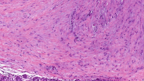 Spindle Cell Lesions | Basicmedical Key