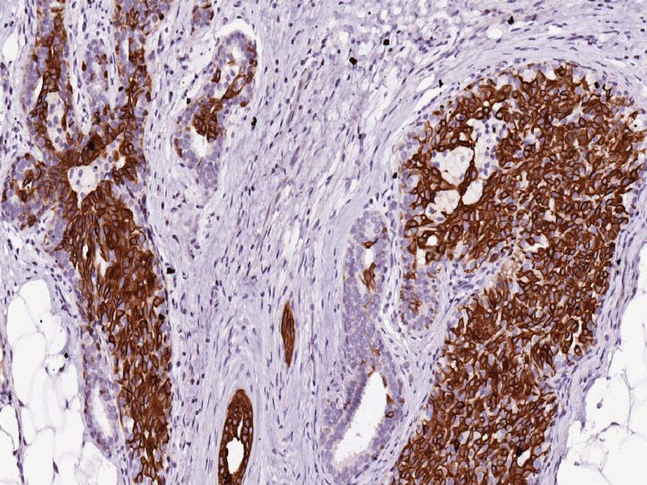 Intraductal Proliferative Lesions | Basicmedical Key