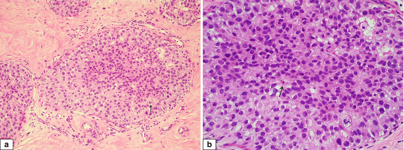 Intraductal Proliferative Lesions | Basicmedical Key