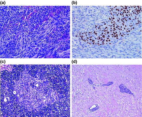 Thymic Epithelial Tumors and Benign Thymic Lesions | Basicmedical Key