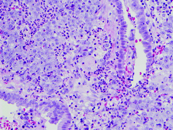 NUT Carcinoma | Basicmedical Key