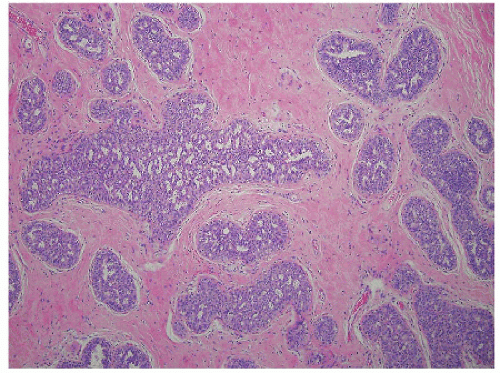 Epithelial Proliferative Lesions, Usual and Atypical Ductal Hyperplasia ...