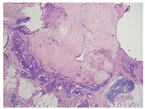 Papillary and Sclerosing Lesions | Basicmedical Key