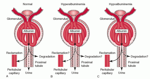 Proteinuria and Nephrotic Syndrome | Basicmedical Key