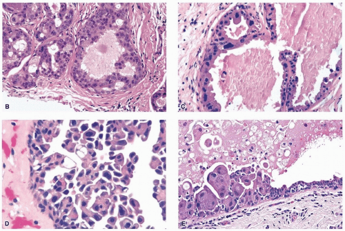 Apocrine Carcinoma | Basicmedical Key