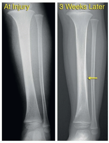 Tibia and Fibula | Basicmedical Key