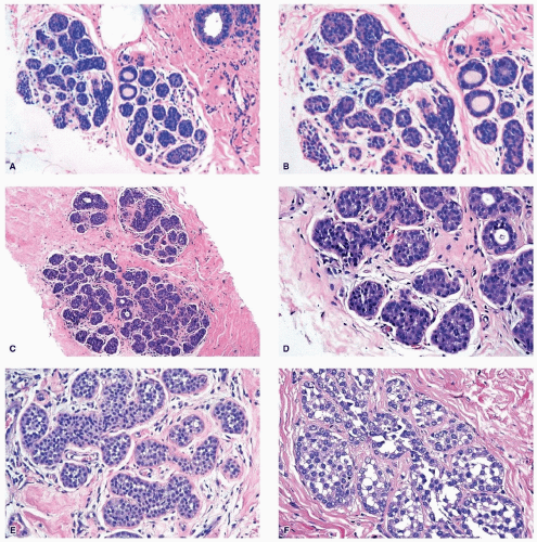 Lobular Carcinoma In Situ and Atypical Lobular Hyperplasia ...