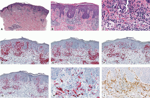 Chronic Actinic Dermatitis—Actinic Reticuloid | Basicmedical Key