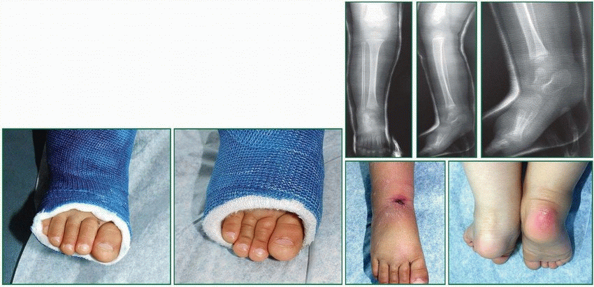 Casts for Children’s Fractures | Basicmedical Key