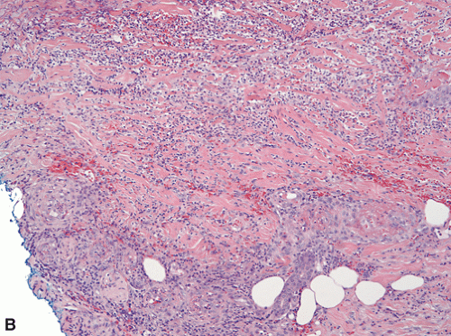 Pyoderma Gangrenosum | Basicmedical Key