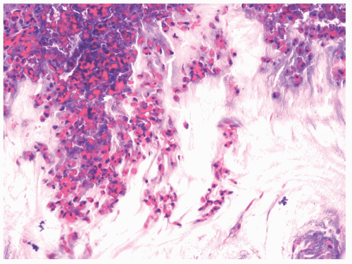 Nonneoplastic Lesions of the Nasal Cavity, Paranasal Sinuses, and ...