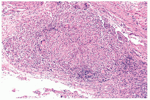 Nonneoplastic Lesions of the Larynx | Basicmedical Key