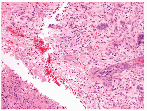 Benign Squamous Proliferations and Neoplasms | Basicmedical Key