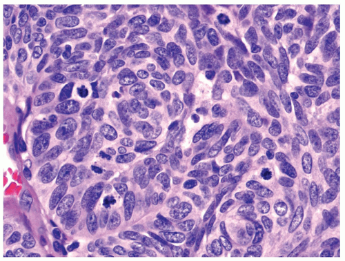 Histologic and Etiologic Variants of Squamous Cell Carcinoma ...