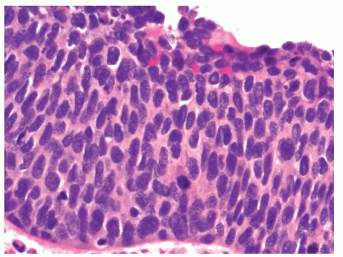 Histologic and Etiologic Variants of Squamous Cell Carcinoma ...
