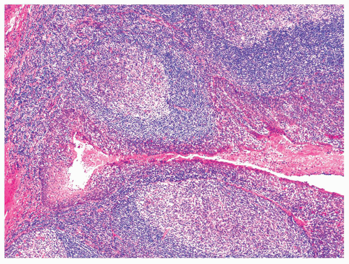 Hematopoietic and Lymphoid Disorders | Basicmedical Key