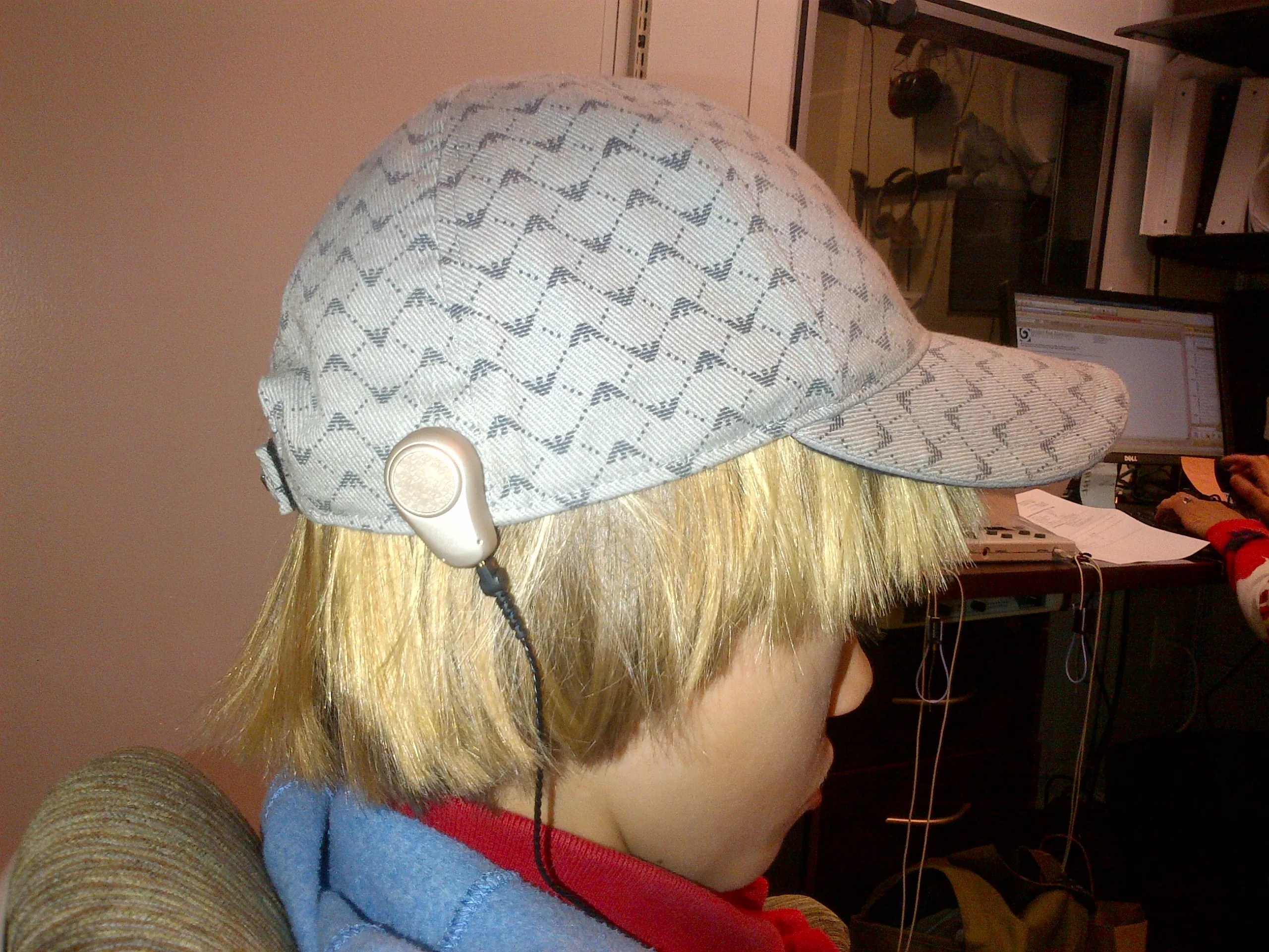 Custom Cap for Ponto | Bone Anchored Hearing Systems (BAHS) Blog