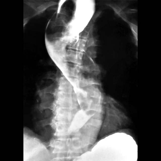 Fibrovascular Polyp | Clinical Gate
