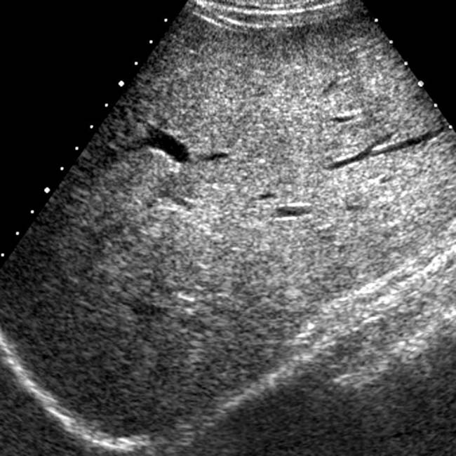 hepatomegaly-clinical-gate