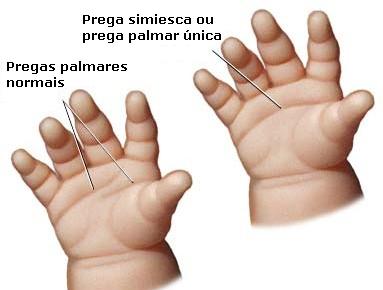 Pregas Palmares/ “Linhas” da Mão – Daniel Bohn