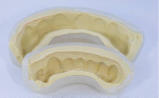 Bonded Functional Esthetic Prototype as a Diagnostic Aid